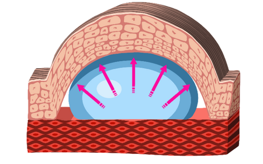Novoglan Tight Foreskin Phimosis Treatment – NOVOGLAN